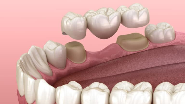 Dental Bridges in Orlando, FL - Colonial Town Dental